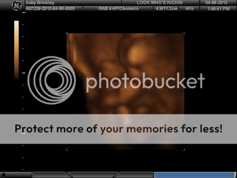 Ultrasound showed indentation in head - BabyCenter